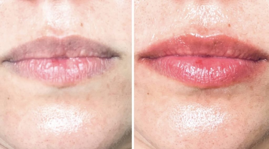 Hydrafacial Perk® Lip/Restorsea | DermApproach | Reston VA